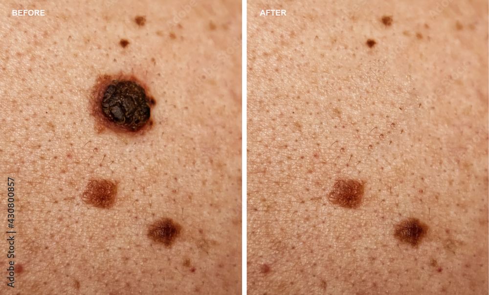 Photo before and after removal of mole on woman skin. Mole removal ...