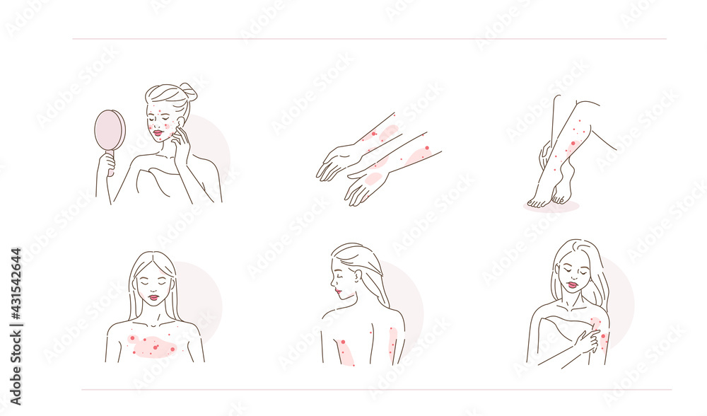 Beauty Girl Have Allergy and Acne Skin Problems. Woman Scratching her ...