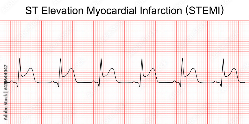 Electrocardiogram show ST elevation myocardial infarction (STEMI) pattern. Heart attack ...