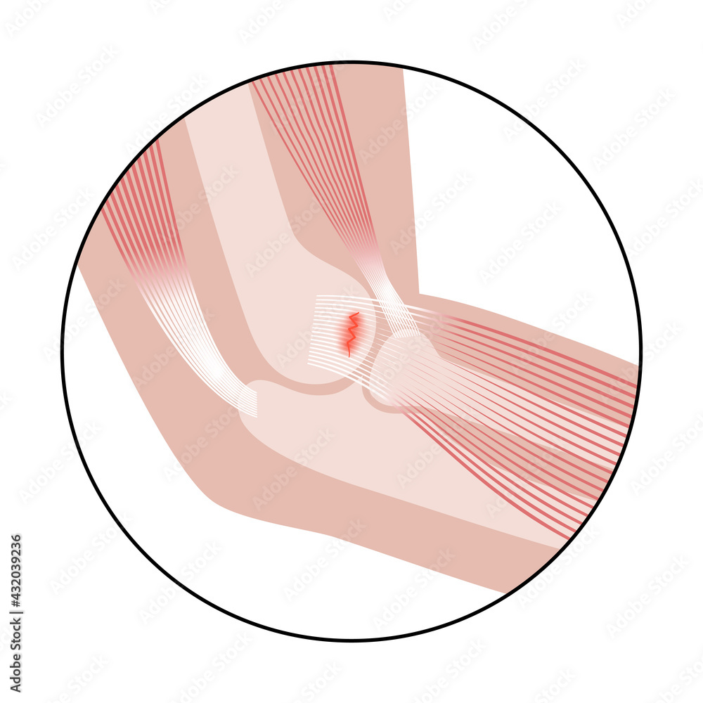 Lateral epicondylitis tennis elbow Stock Vector | Adobe Stock
