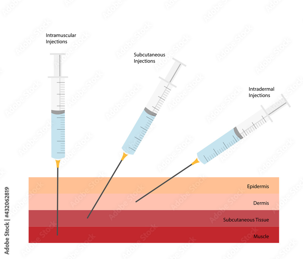 Differents Syringe Angles injections. Intramuscular, subcutaneous and ...