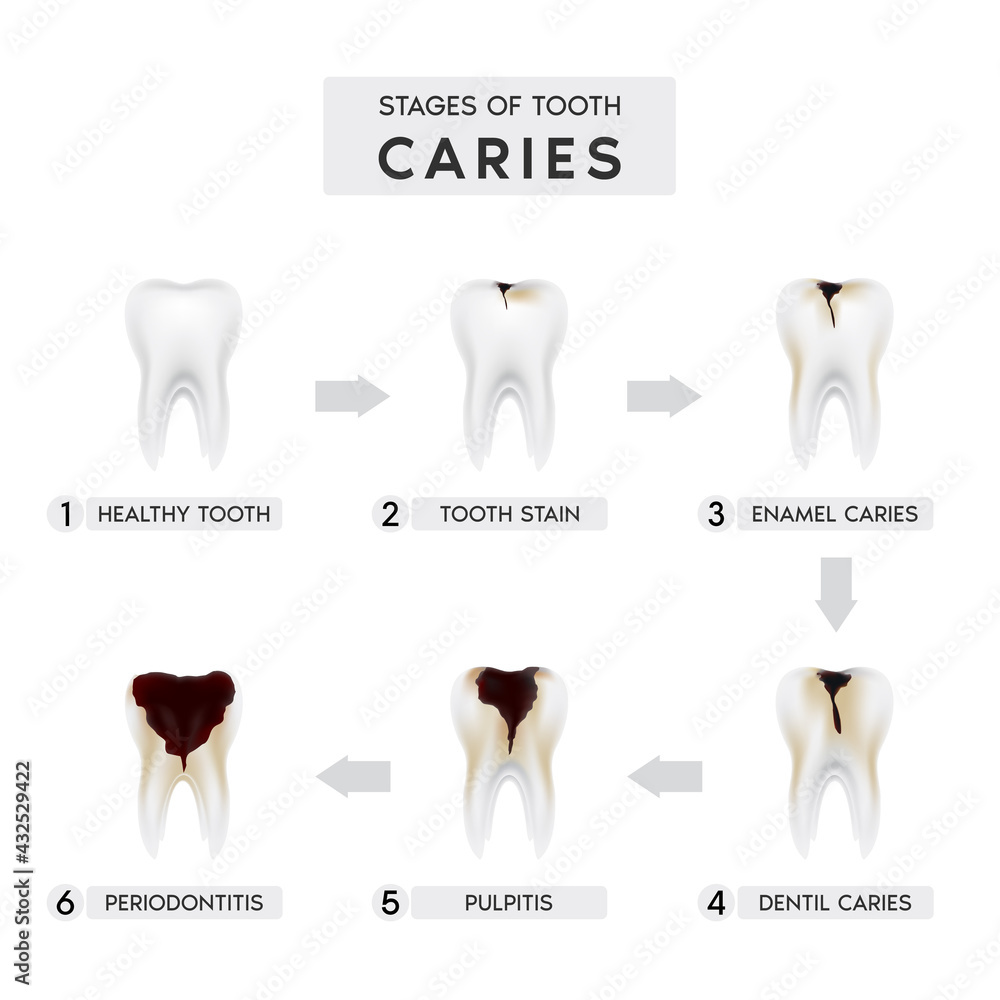 Vektor Tooth caries structure and Progression and Treatment: Dental ...