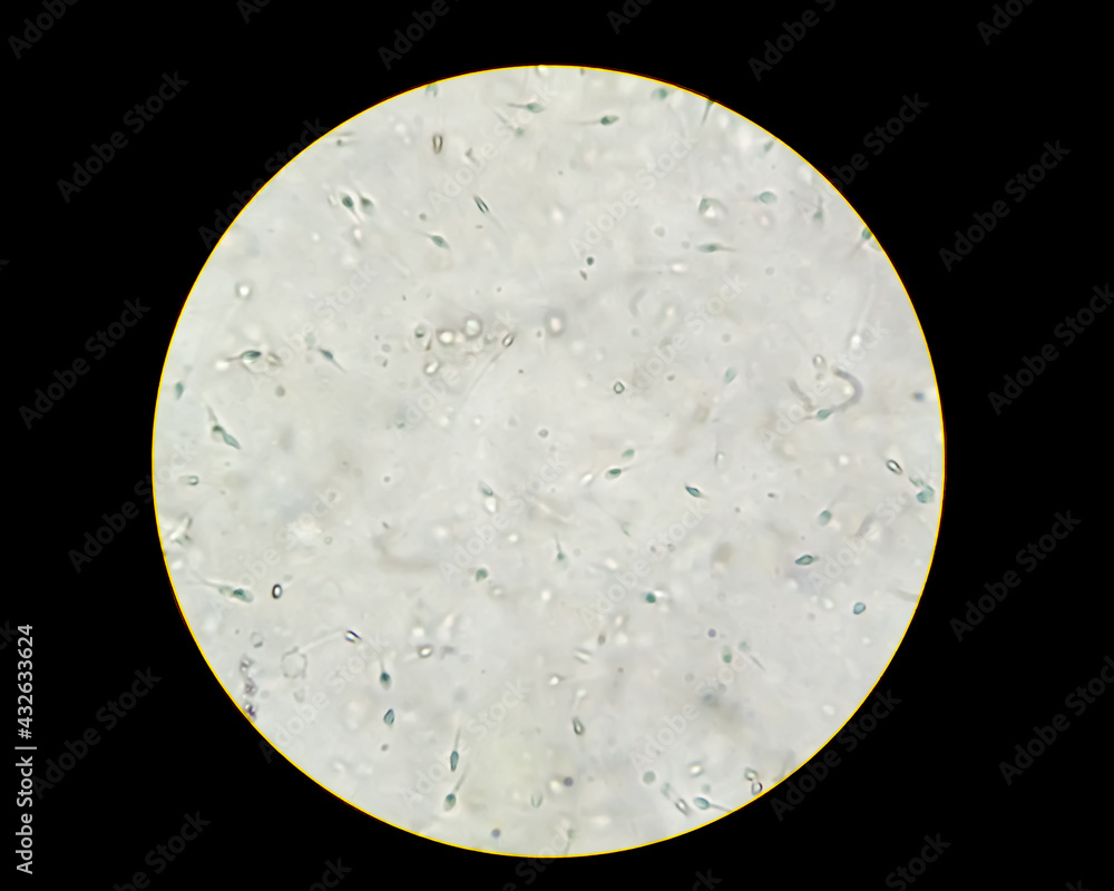 Semen analysis, sperm analysis on microscopic examination. Micrograph ...