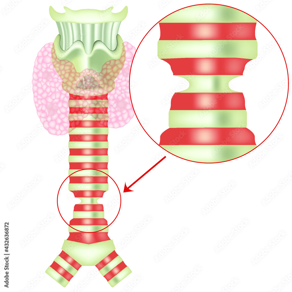 Tracheal stenosis. Thyroid. Respiratory and endocrine system anatomy ...