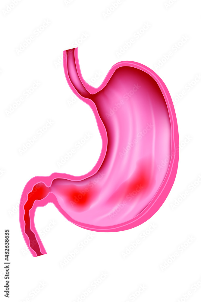 gastroduodenitis. Inflammation of the mucous membranes of the stomach ...