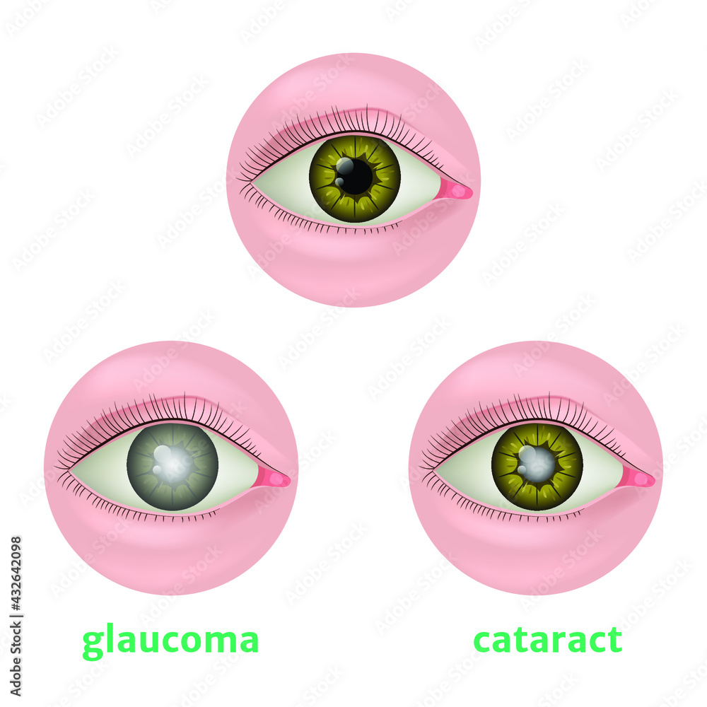 cataracts and glaucoma. Eye diseases leading to blindness. Clouding of ...