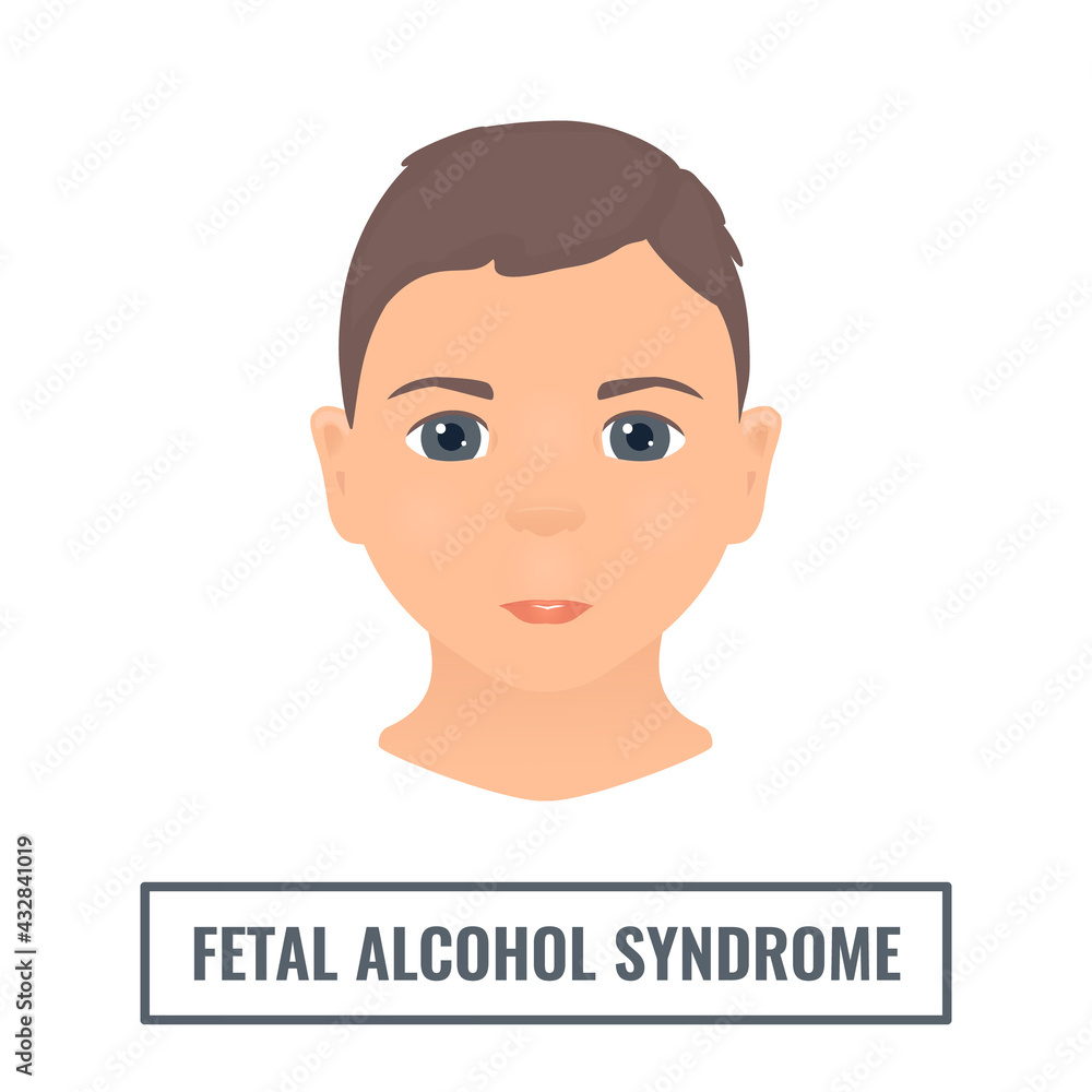 Facial features in a child with fetal alcohol syndrome. Foetal alcohol ...