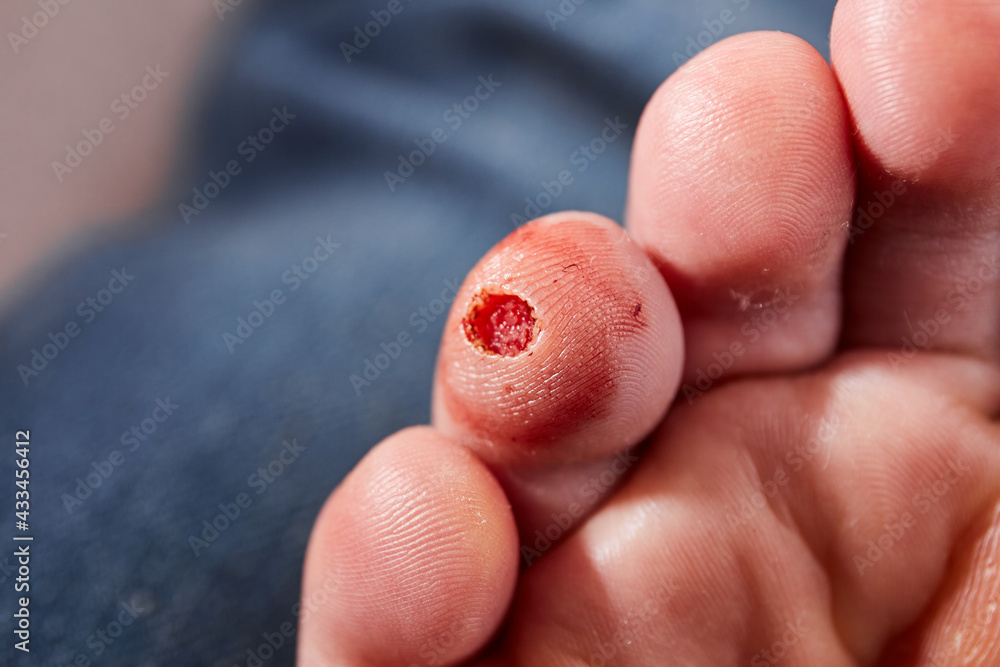 Laser removal of wart from the toe of foot. Cut out verruca ...