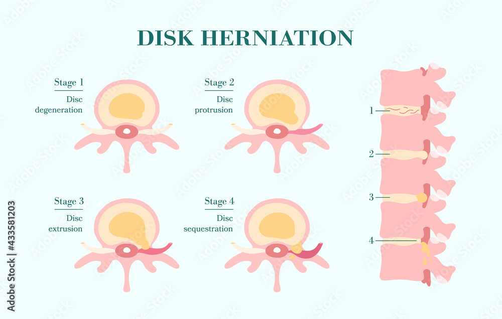 Herniated spinal disc - Degenerative, Protrusion, Extrusion, Sequestration - vector patient ...