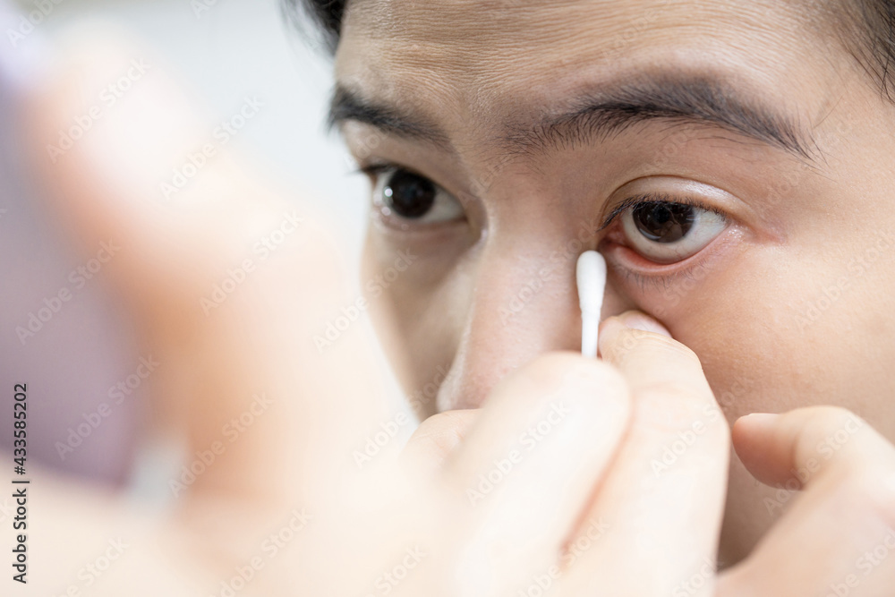 Female using a cotton bud swab to wipe clean the swollen,itchy area ...