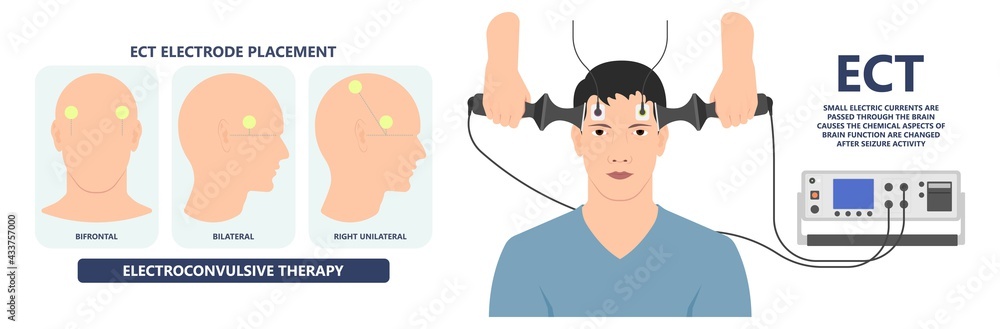 ECT treat MDD Major TMS electric current brain mental health mania ...