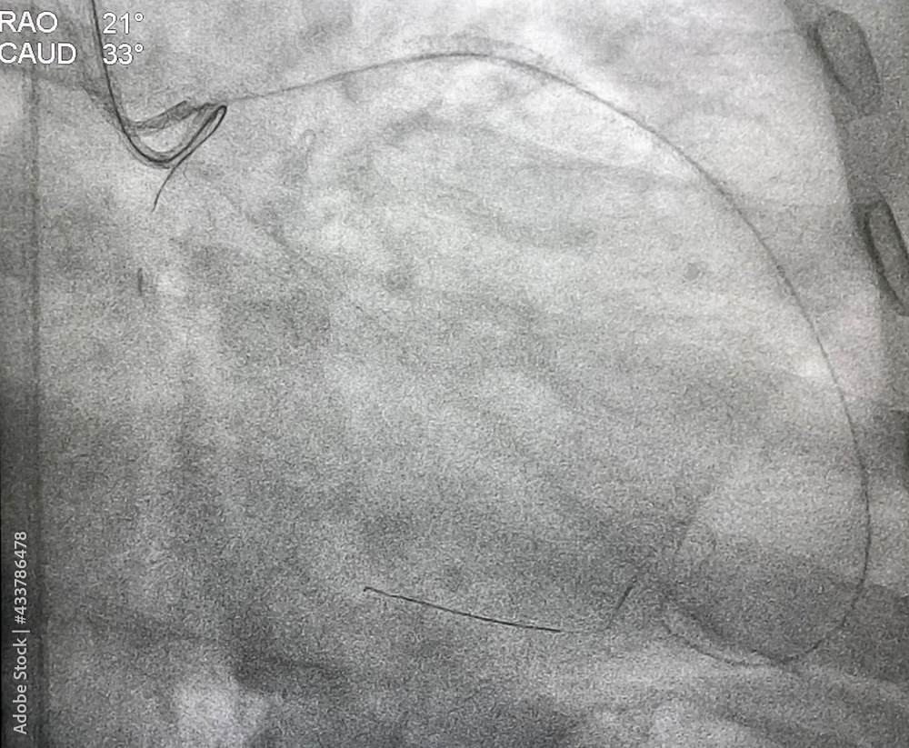 Retrograde guide wire to right coronary artery (RCA) in coronary ... Retrograde guide wire to right coronary artery (RCA) in coronary ...