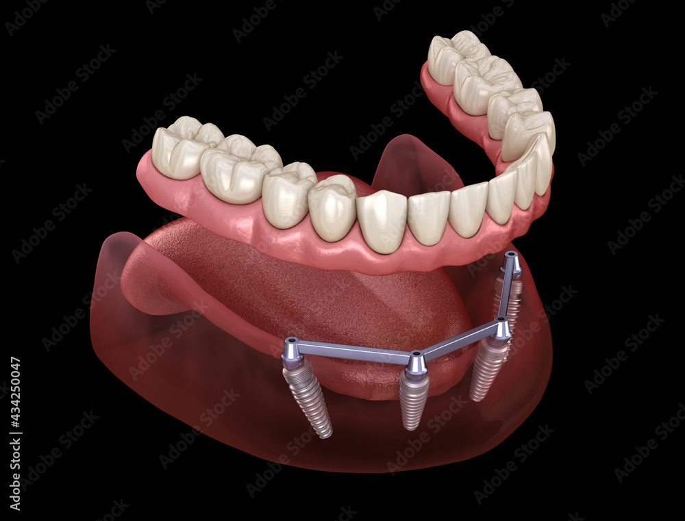 Mandibular prosthesis with gum All on 4 system supported by implants ...