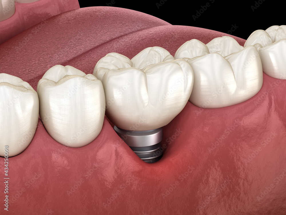 Peri-implantitis with visible gum recession. Medically accurate 3D ...