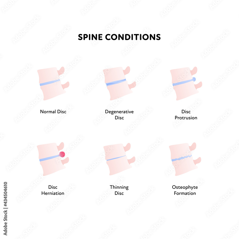 Spine disk condition. Vector flat anatomical illustration. Icon set ...