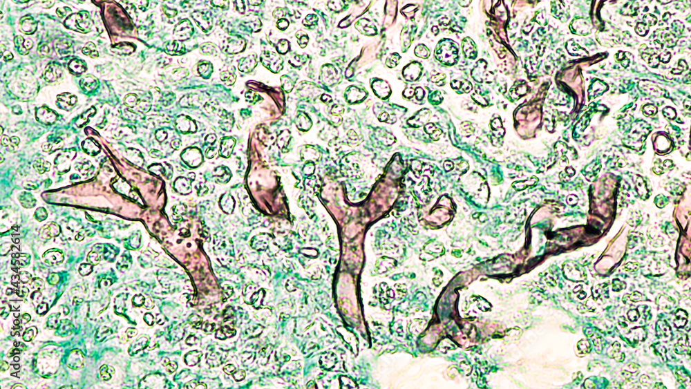 Fungal Infection - Mucormycosis: Broad, wide-angle non-septate hyphae ...