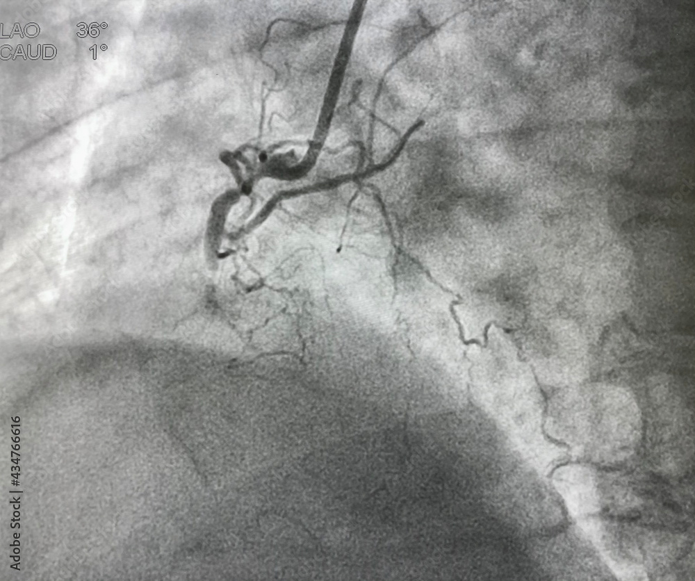 coronary angiogram shown massive thrombus that occluded right coronary ...