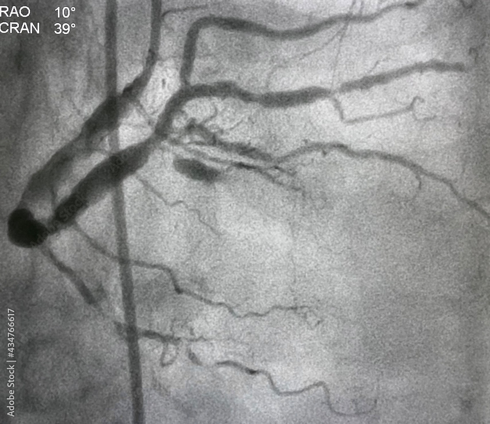 coronary angiogram shown massive thrombus that occluded right coronary ...