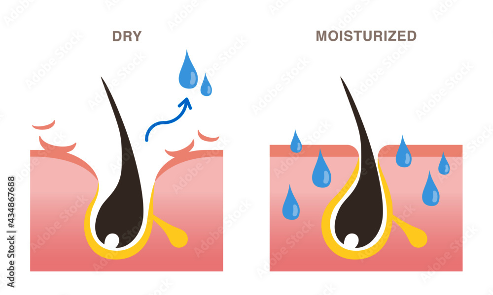 Skin cross section of pore types. Moisturized pore and dry pore. Pale ...