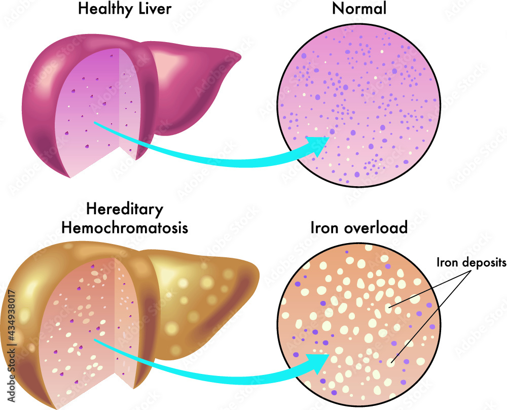 Medical illustration shows the difference between a healthy liver and ...