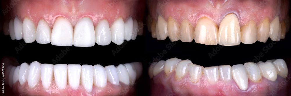 Perfect smile whitening before and after veneers bleach of zircon arch ...