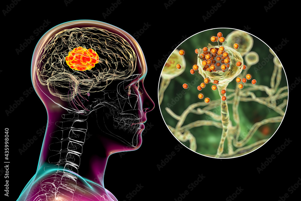 Brain mucormycosis, a brain lesion caused by fungi Mucor, also known as ...