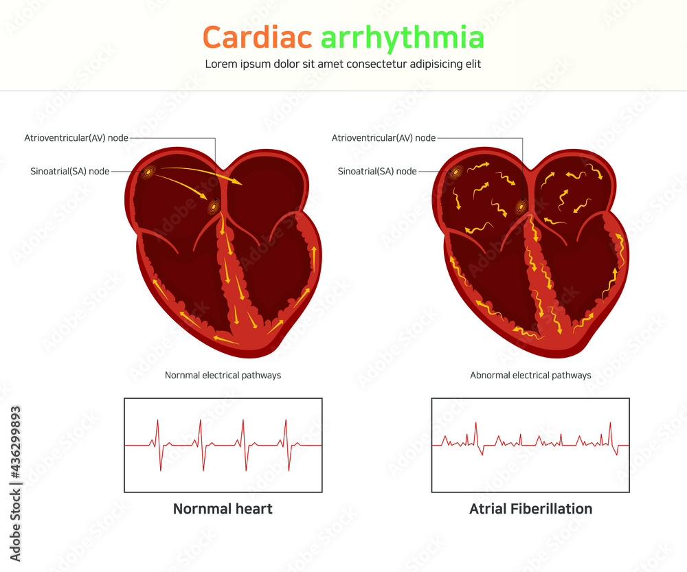 Cardiac arrhythmia. wolff-parkinson-white syndrome. atrial fibrillation ...
