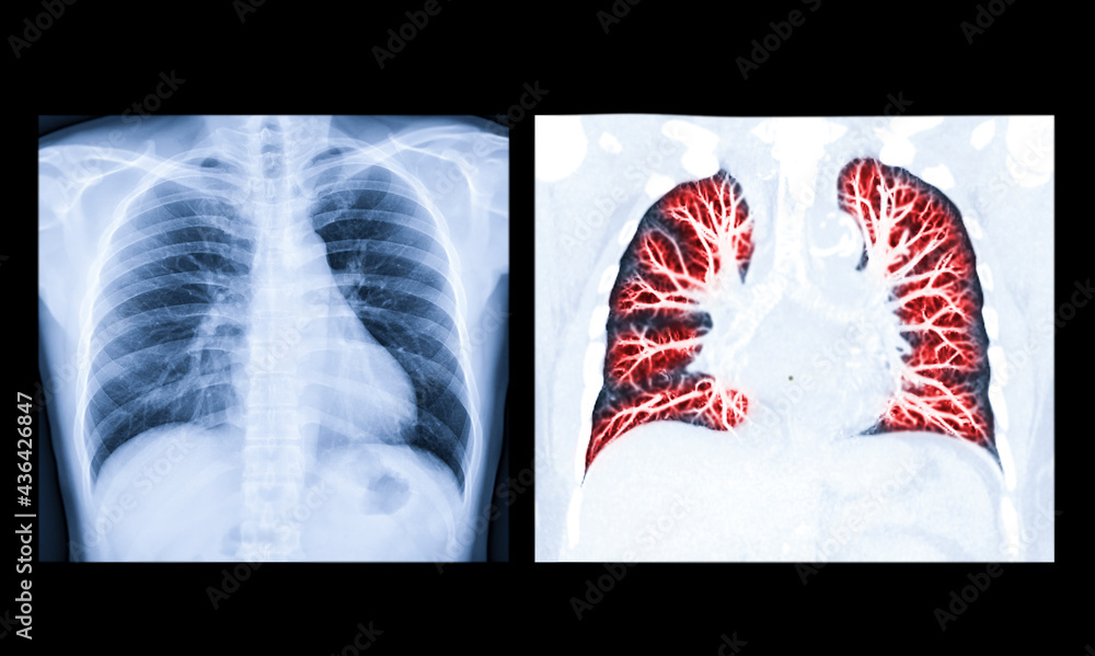 Chest X-ray or X-Ray Image Of Human Chest or Lung Lateral view( red ...