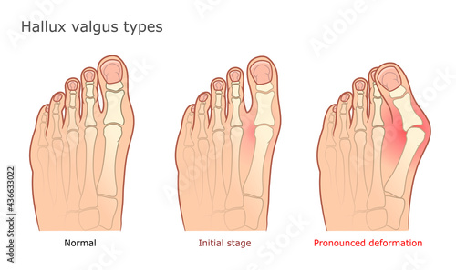 Medical vector illustration of Hallux valgus types. Healthy foot ...