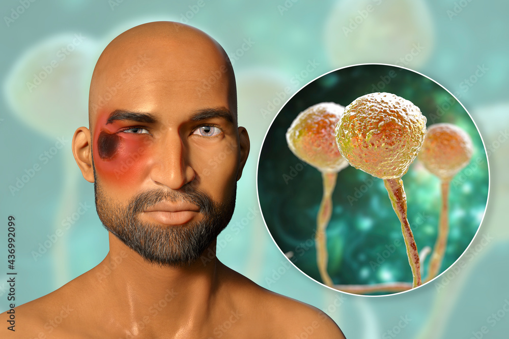 Periorbital cutaneous mucormycosis, a disease caused by Mucor fungi. A ...