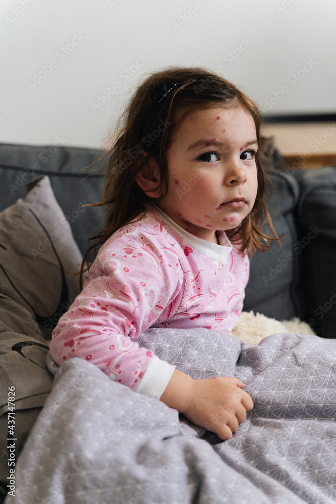 Toddler girl with chickenpox measles on the body. Varicella virus ...