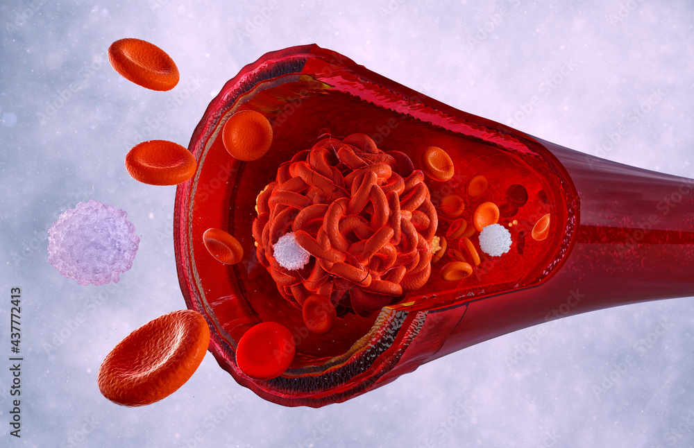 Blood cells clot in the human body blood vessels. Artery, vein blockage ...