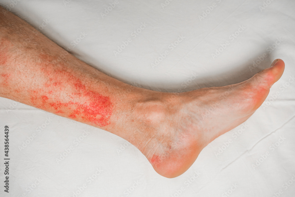 Disease of the skin on the legs, itchy red rashes and spots Stock Photo ...
