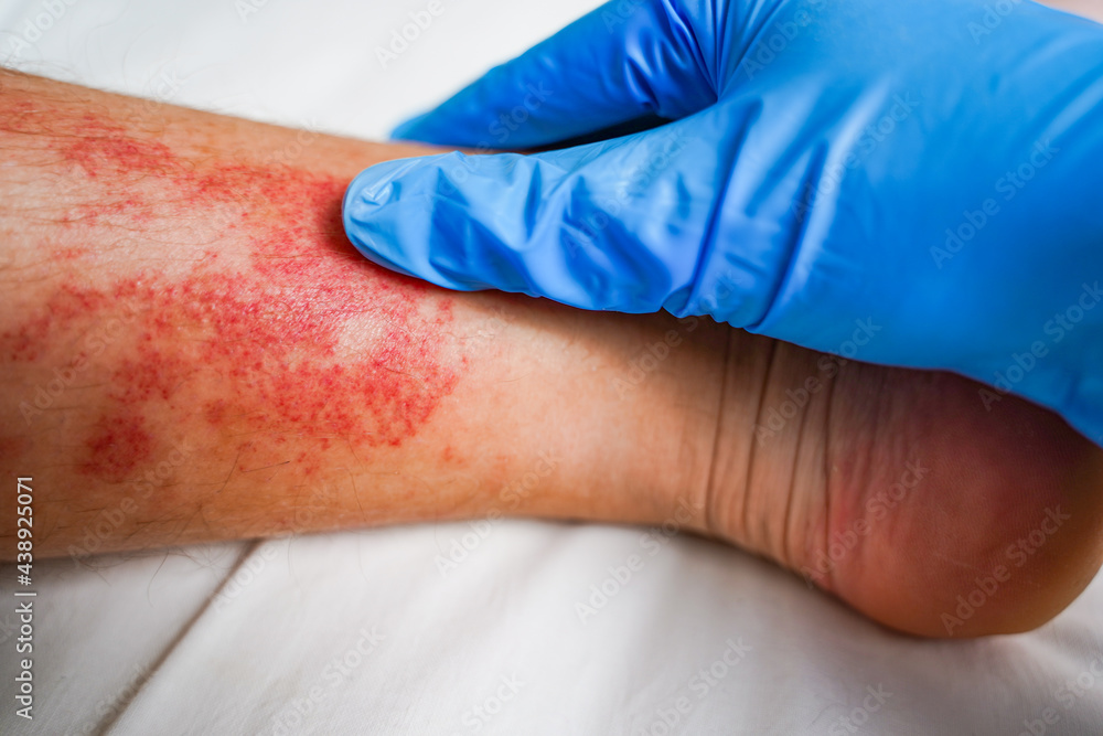 Disease of the skin on the legs, itchy red rashes and spots Stock Photo ...
