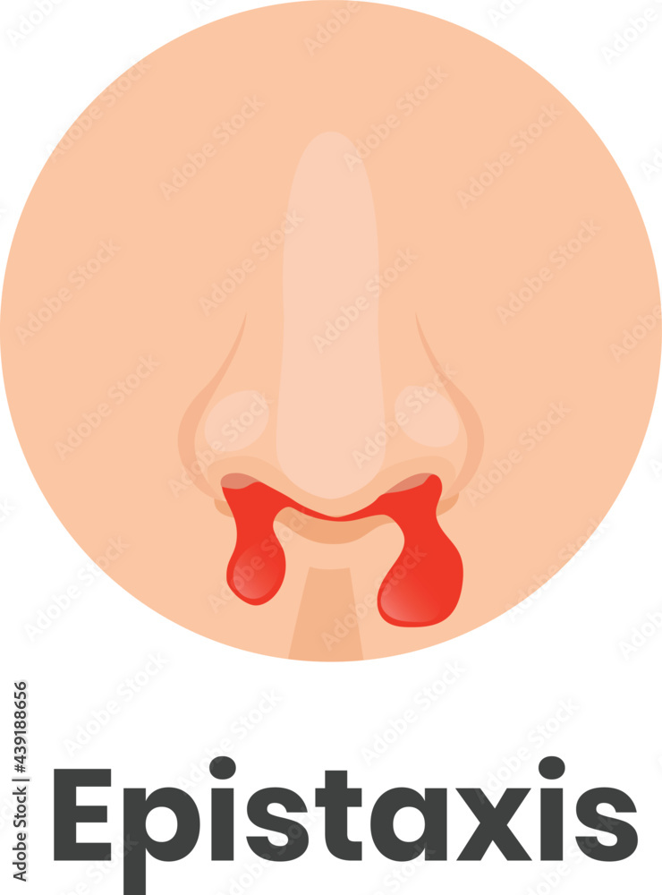 Nosebleed icon. Epistaxis concept. Bleeding from the nose Stock Vector | Adobe Stock