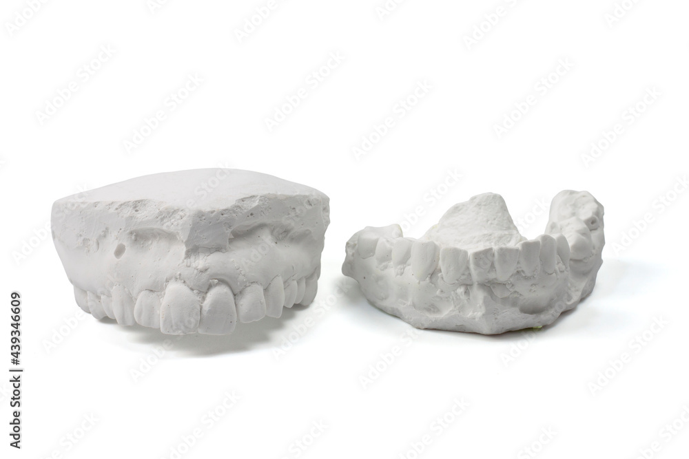 Cast gypsum model plaster for dental molar teeth before braces in ...