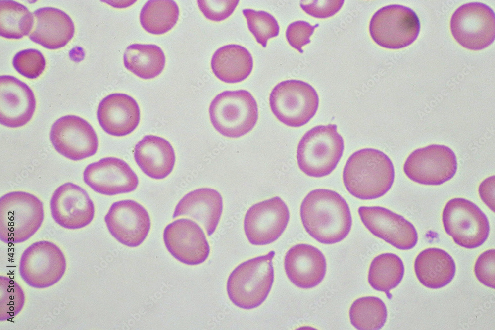 Target cells with abnormal red blood cells in blood smear, specimen ...