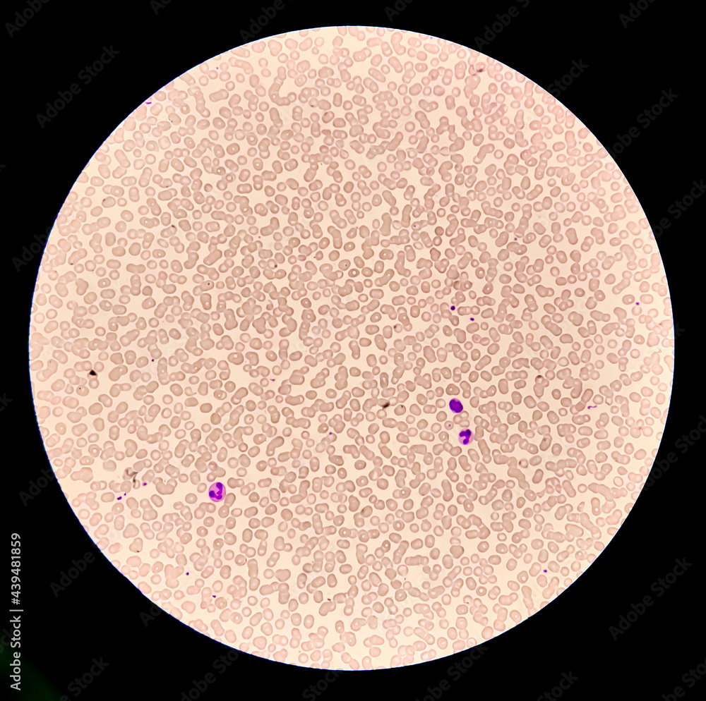 Foto de Stock Microscopic blood smear or slide show increased number of ...