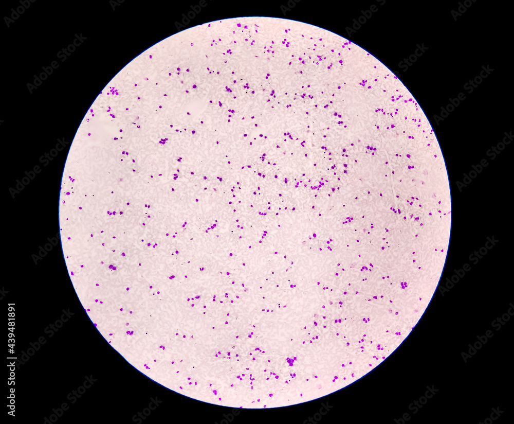 Acute myeloid leukemia (AML) is a type of blood cancer. Microscopic ...