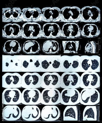 High resolution computed tomography images of a normal thorax in axial ...