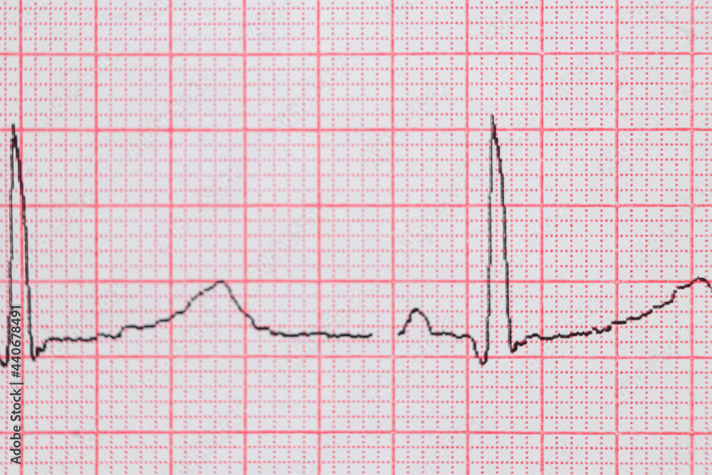 Heart electrocardiogram EKG chart on special paper. Concept for heart ...