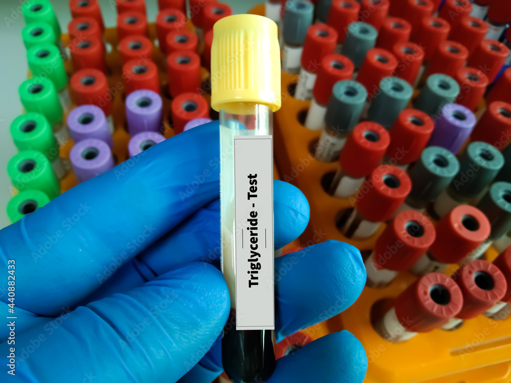 Lipemic Serum blood sample tube holding by Medical Technologist. To ...