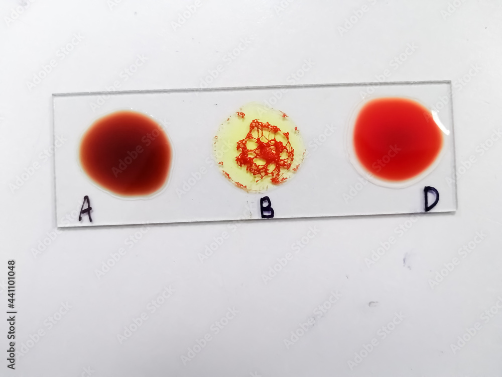 Blood group testing by slide agglutination method,show B Negative ...