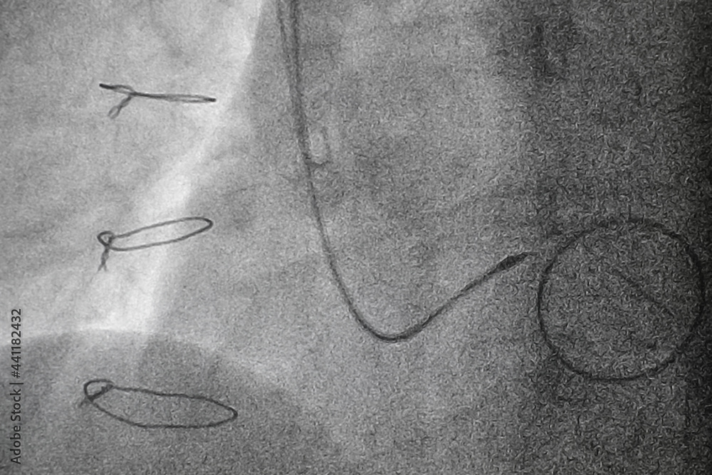 Photo Stock cardiac, heart, cardiology, vascular, cardiovascular ...