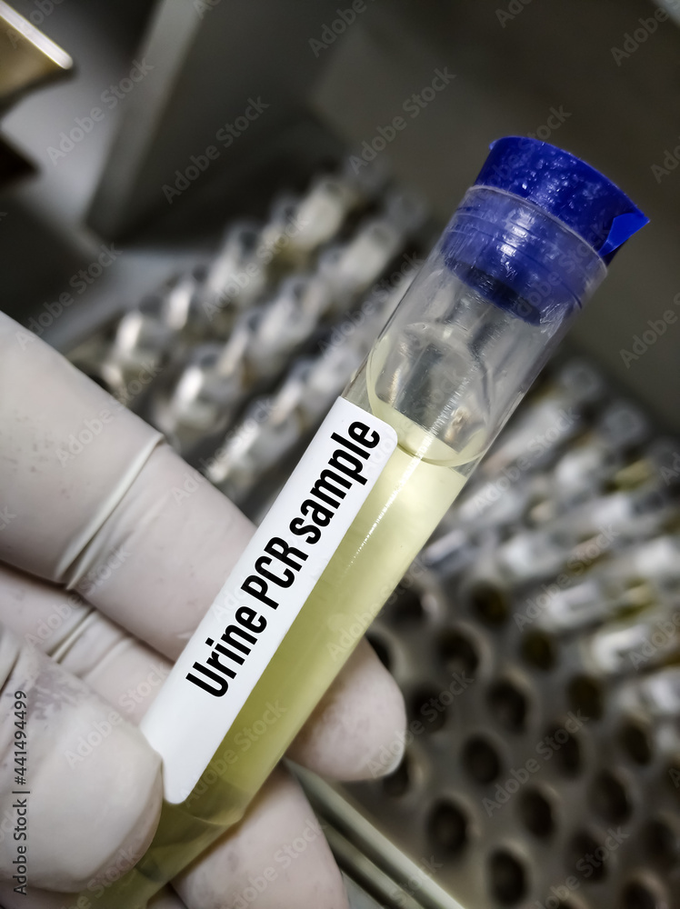 Urine Sample for Urine PCR(Protein-Creatinine Ratio).lab test of ...