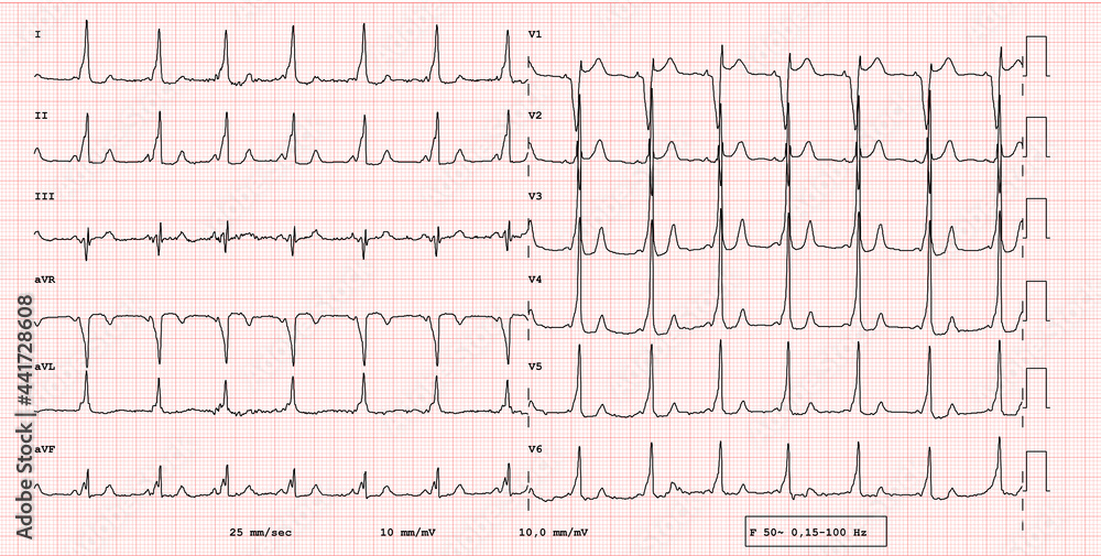 ECG example of a pathological 12-lead rhythm, ventricular pre ...