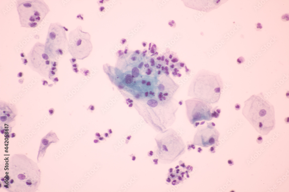 View in microscopic of Abnormal human cervix cells.Squamous epithelium ...