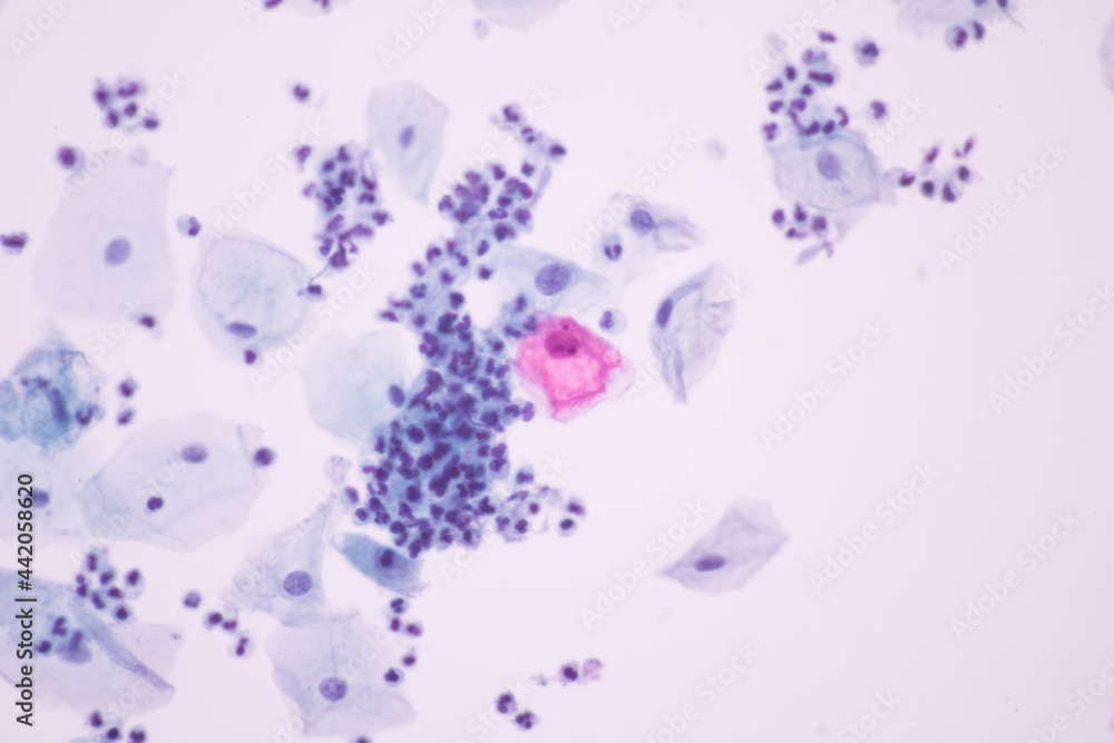 View in microscopic of Abnormal human cervix cells.Squamous epithelium ...