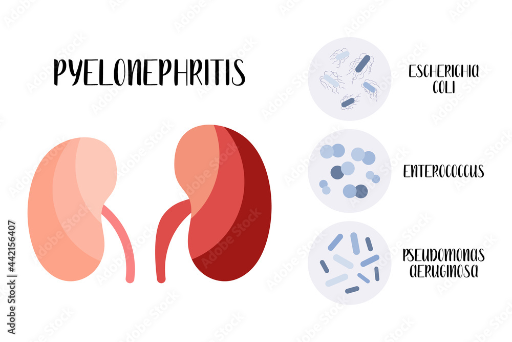 Pyelonephritis. Kidney, urinary system inflammatory disease. Pathogen ...