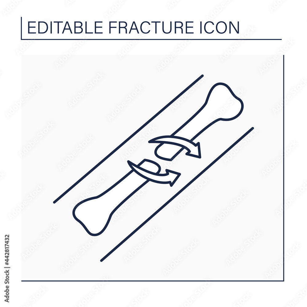 Spiral fracture line icon, Fractures of long bones from rotational ...